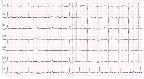 Dyspnoea With Diffuse T Wave Inversion The Bmj