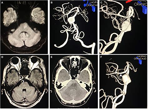 Frontiers Partial Clipping Occlusion Including Rupture Point Is An