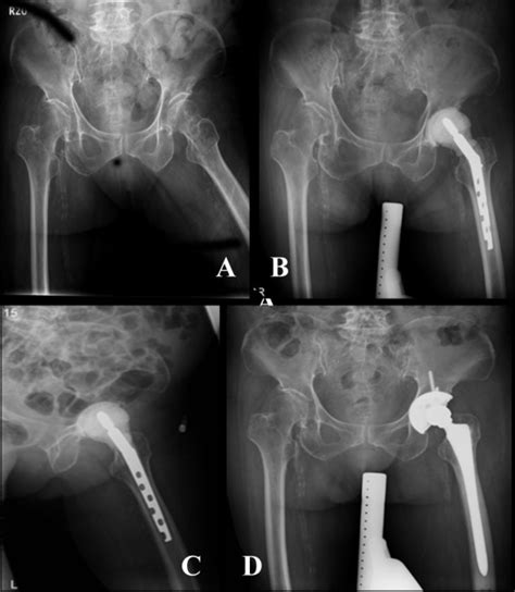 A A Patient With Left Primary Hip Septic Arthritis B C The Patient