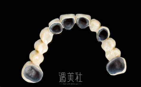 镍铬烤瓷牙的寿命 遇美社