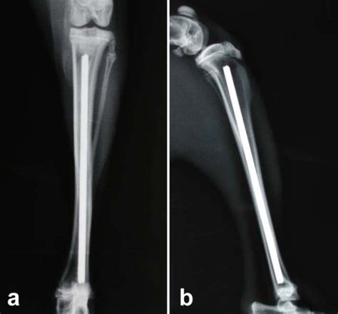 X Ray Of The Tibia Postoperatively A A P View B Lateral View Download Scientific Diagram