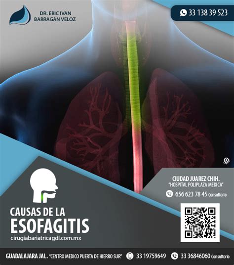 Causas De La Esofagitis La Esofagitis Es Una Irritación Del Esófago