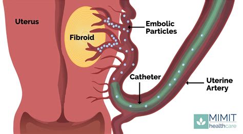 Uterine Fibroid Embolization Ufe Mimit Health