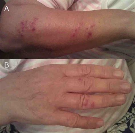 Cervical Dermatomal Zona Misdiagnosed As Ulnar Nerve Entrapment Pmc