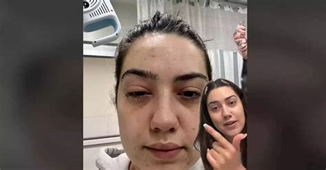 Viral Tiktok Shows Ontario Womans Infection From Swimming At Wasaga