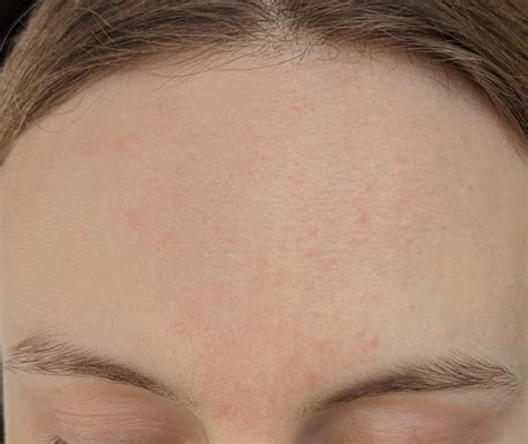 Textured Forehead Is This Seborrheic Dermatitis R Seborrheicdermatitis