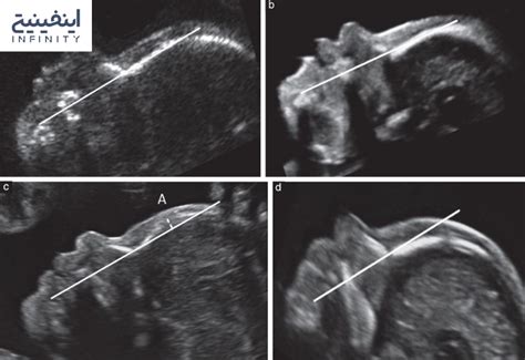 سندرم داون چیست علائم و علل ایجاد سندروم داون فروشگاه اینفینیتی