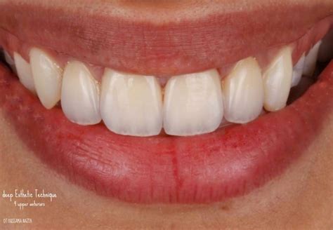 Oussama Nazih On Linkedin 4 Upper Emax Crownsandveneers