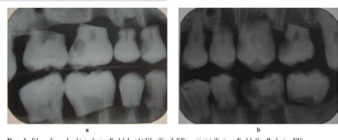 figure 1 from proximal caries detection accuracy using intraoral