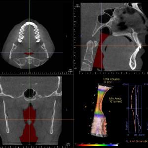 What Is Upper Airway Resistance Syndrome UARS