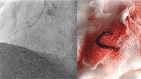 Stemi