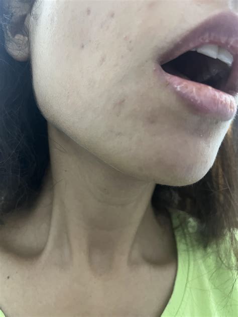 Is This A Cold Sore At Edge Of Lower Lip Small Bump Mostly White Head