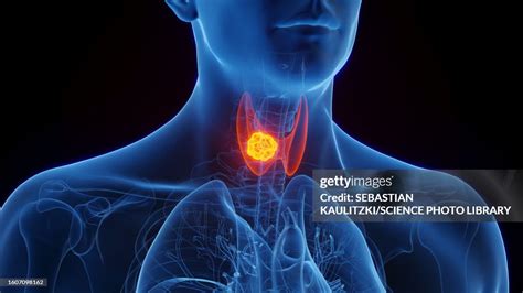 Thyroid Cancer Illustration High Res Vector Graphic Getty Images