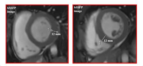 Figure E Concentric Left Ventricular Hypertrophy Of Basal And Mid