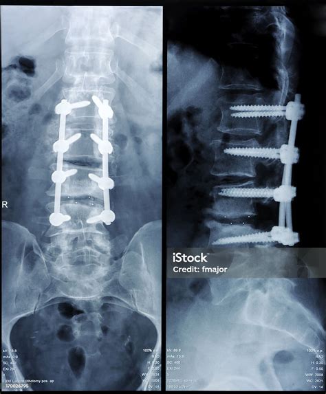 Spondylolisthesis Surgery Before And After