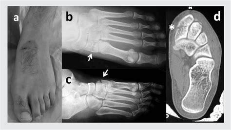 Table 1 From Isolated Medial Cuneiform Fractures Semantic Scholar