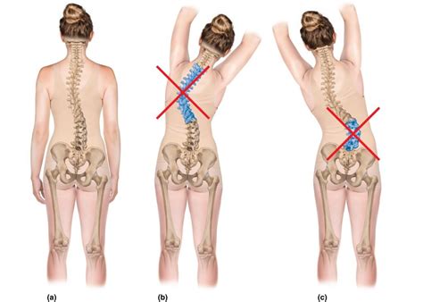 Scoliosis Stretching Exercises