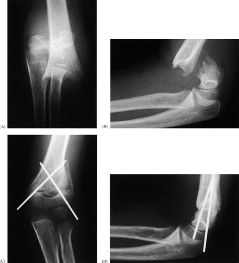 Neurovascular Complications And Functional Outcome In Displaced