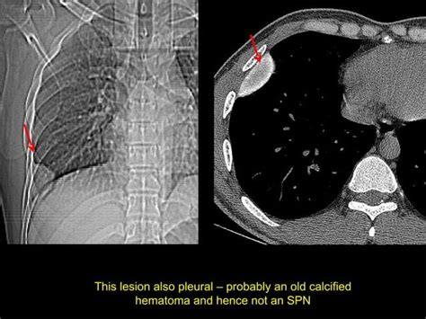 Solitary Pulmonary Nodule Spn Ppt
