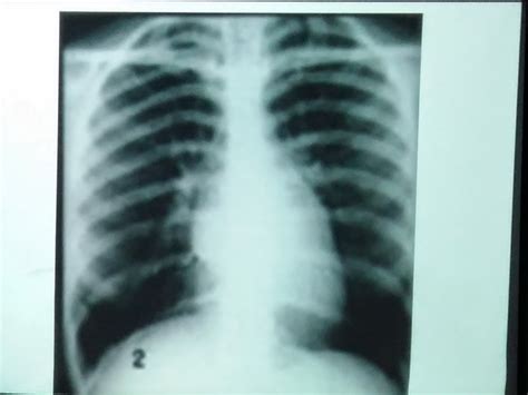 Lecture Slides Cardiology Mitral Stenosis