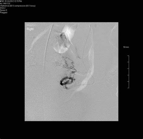 Pseudoaneurysm After Abdominal Myomectomy A Rare But Catastrophic Complication