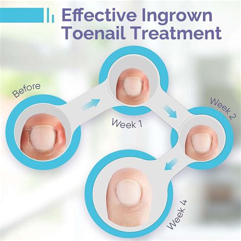 Ingrown Toenail Treatment And Pain Reliever Softens For Easy Trimming