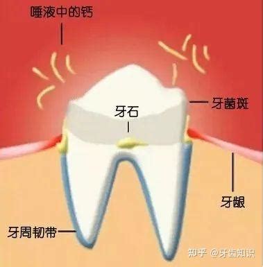 怎么防止下门牙内侧长牙结石 知乎