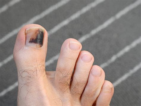 Nail Bed Injury Pictures Types And Treatments Off