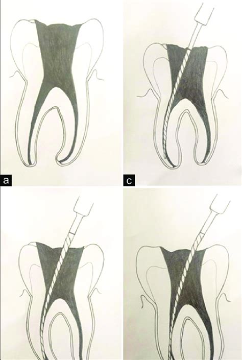 Schematic Representation Showing Normal Canal Morphology A Ledge