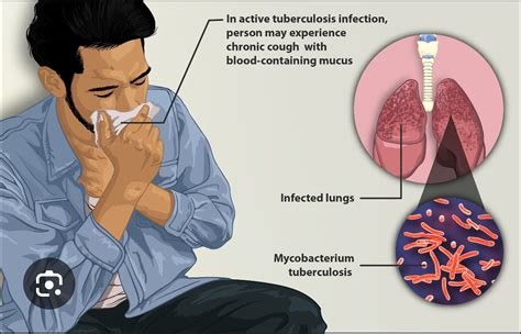 St Maximillian Tuberculosis Tb Is A Bacterial Infection Caused By Mycobacterium Tuberculosis
