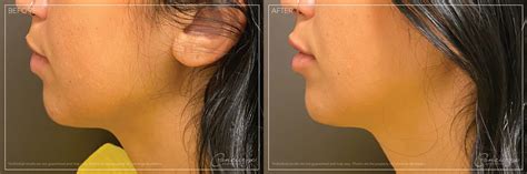 Before And After Juvederm Ultra Chin And Lips Concierge Aesthetics