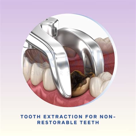 Understanding Dental Pulp Common Diseases Root Canal Therapy And Ad