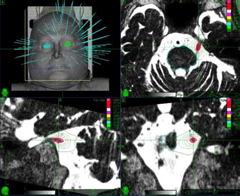 Cyberknife Radiosurgery For Trigeminal Neuralgia Pmc
