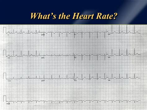 Pediatric Egc Interpretation Overview Of Pediatric Ecg Pdf