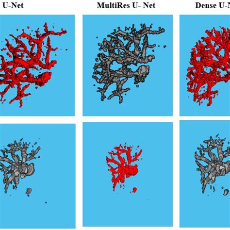 Results Of 3 D Models For The Segmentation Of Liver Vessels Without