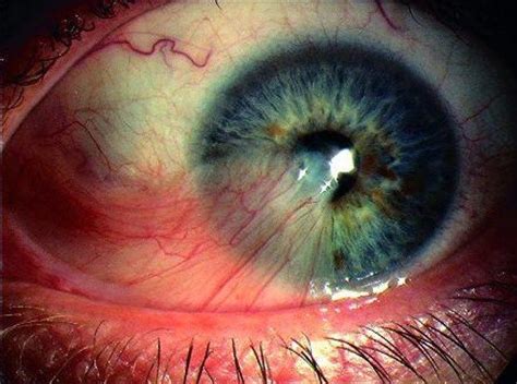 17 Best Images About Cornea Love On Pinterest Stem Cells Lattices And For Eyes