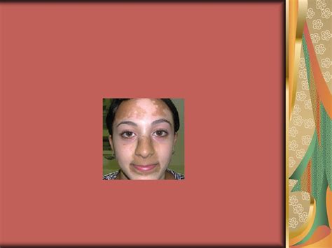 Hypopigmentation Disorders Ppt Download