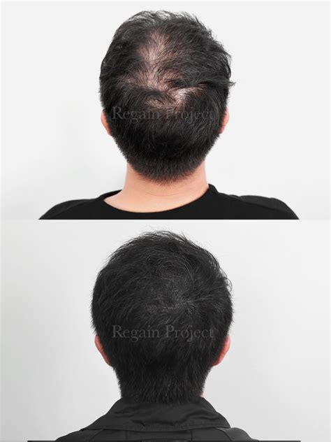 정수리두피문신 성공 포인트 딱 한가지만 알려드려요