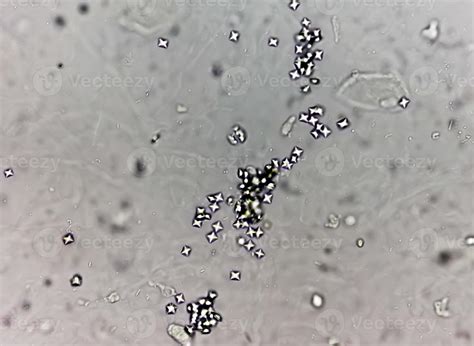 Imagen Microscópica Que Muestra Cristales De Oxalato De Calcio Del