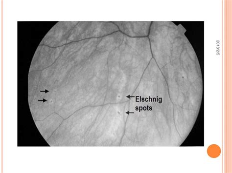 Hypertensive Retinopathy Ppt Download