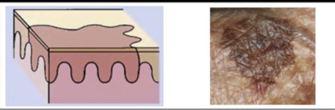 Wgs Integumentary System Skin Abnormalities Flashcards Quizlet