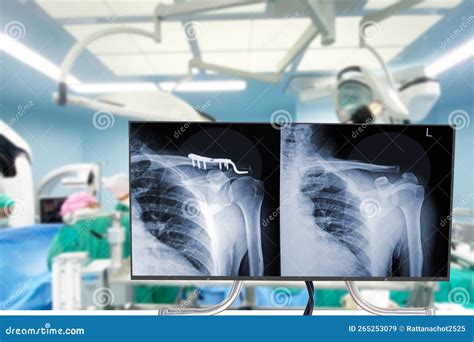 X Ray Clavicle Bone Fracture Which Treated By Surgery And Plate