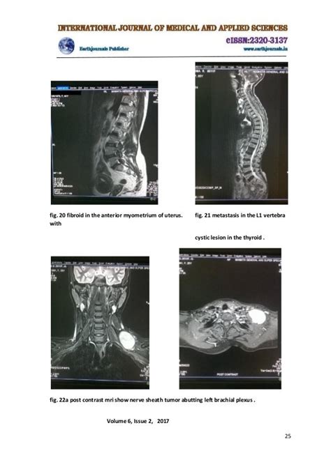 Incidence Of Incidental Findings On Mri Spine And Patient Benefits