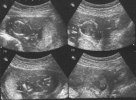 Oligohydramnios Definition New Health Advisor