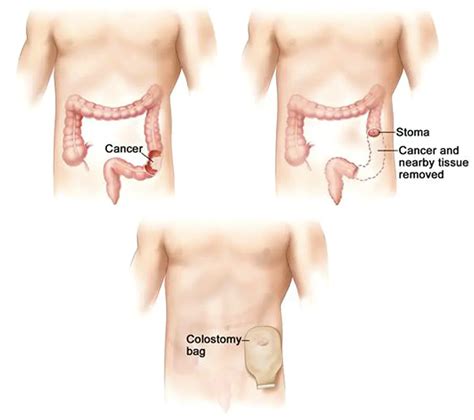 Ileostomy Vs Colostomy Colostomy Ileostomy Ostomy Colostomy Vs