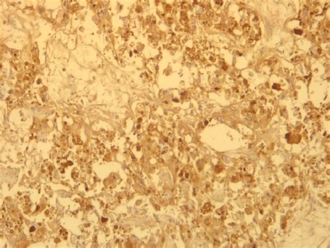 The Immunostaining Showing Diffuse Positivity For Afp Download Scientific Diagram