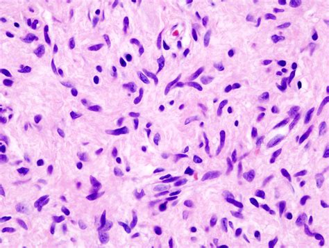 Neurofibroma Libre Pathology