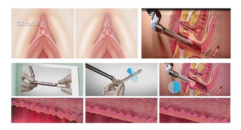 Co Fractional Laser Beauty Equipment Co Carboxy Therapy Equipment Buy Co Carboxy Therapy