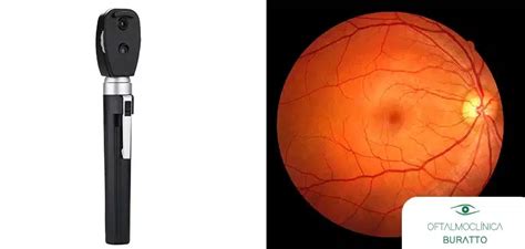 Fundoscopia Sob Midríases Oftalmoclínica