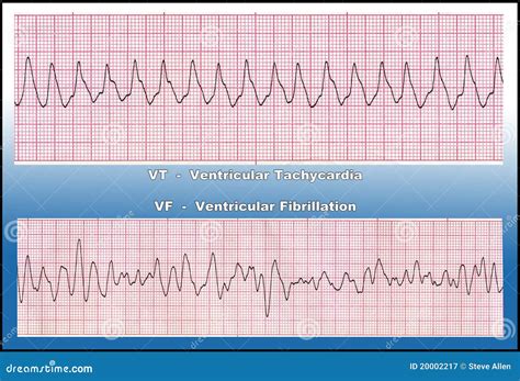 Medicine Deadly Heart Arrhythmia Vt And Vf Royalty Free Stock